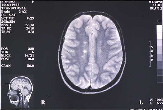 Healthy Brain Vs Ms Brain